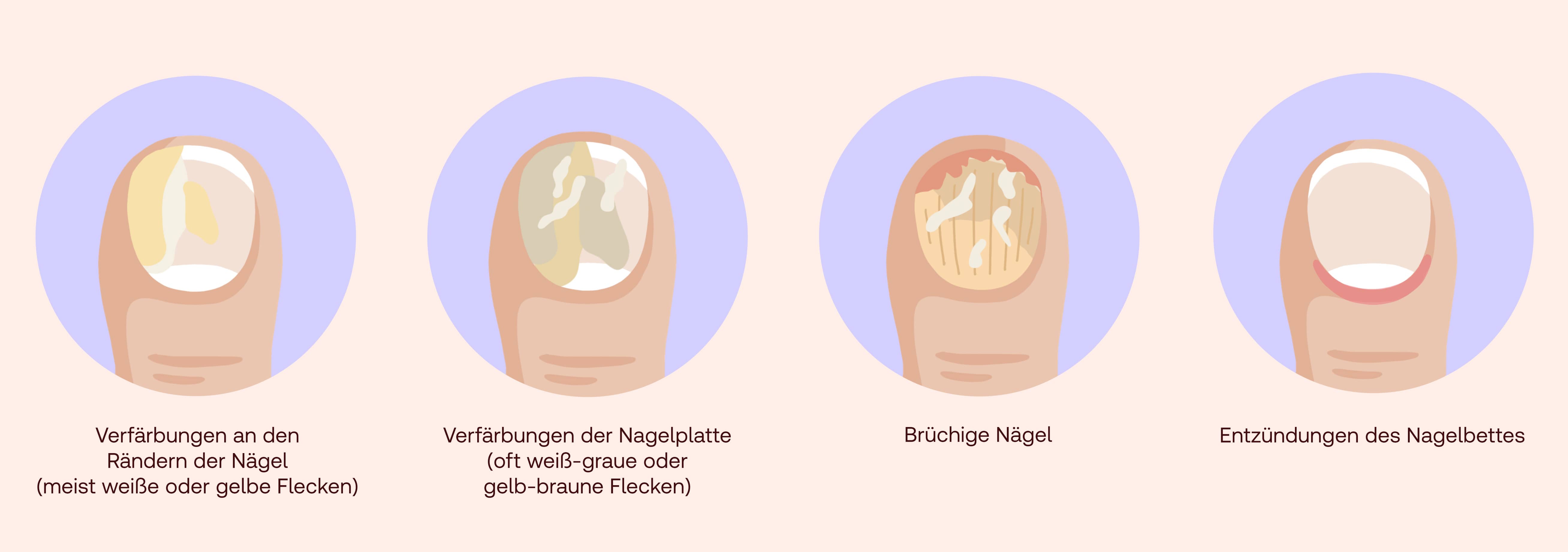Nagelpilz Symptome Behandlung Shop Apotheke Nagelpilz Symptome Behandlung Shop Apotheke